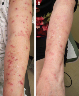 The Other Itch That Rashes: a Clinical and Therapeutic Approach to ...