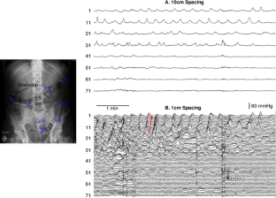 High Resolution Colonic Manometry – What Have We Learnt?- a Review of ...