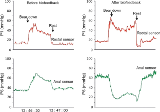 A Practical Guide to Biofeedback Therapy for Pelvic Floor Disorders ...