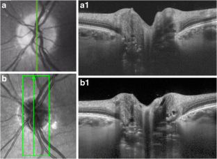 Optical Coherence Tomography to Differentiate Papilledema from ...