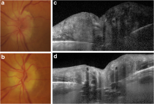 Optical Coherence Tomography to Differentiate Papilledema from ...