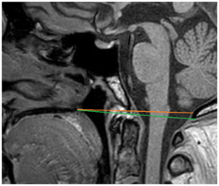 Basilar Invagination, Basilar Impression, and Platybasia: Clinical and ...