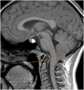 Basilar Invagination, Basilar Impression, and Platybasia: Clinical and ...