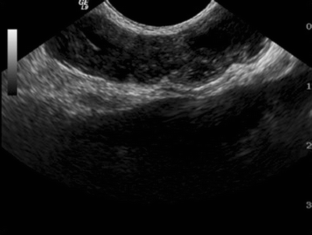Ejaculatory Duct Obstruction: Current Diagnosis and Treatment ...