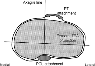 Rotational Position of Femoral and Tibial Components in TKA Using the ...
