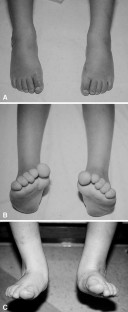 Tibialis Anterior Tendon Transfer after Clubfoot Surgery | SpringerLink