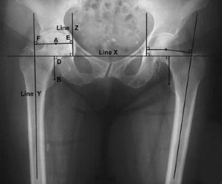 Hip Offset in Total Hip Arthroplasty: Quantitative Measurement with ...