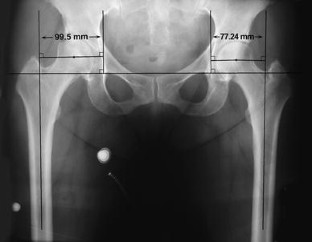 Hip Offset in Total Hip Arthroplasty: Quantitative Measurement with ...