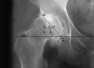 Hip Offset in Total Hip Arthroplasty: Quantitative Measurement with ...