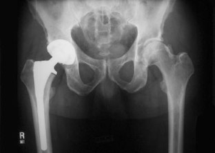 Hip Offset in Total Hip Arthroplasty: Quantitative Measurement with ...