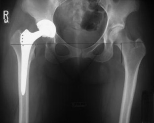 Hip Offset in Total Hip Arthroplasty: Quantitative Measurement with ...