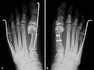 The SERI Distal Metatarsal Osteotomy and Scarf Osteotomy Provide ...