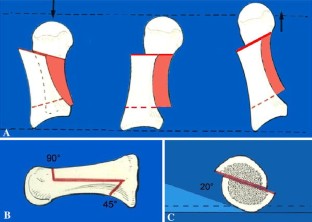 The SERI Distal Metatarsal Osteotomy and Scarf Osteotomy Provide ...