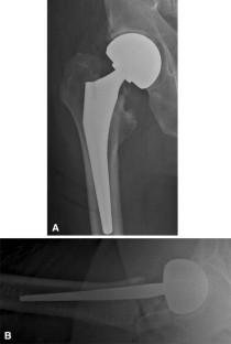 Adverse Local Tissue Reaction Associated With a Modular Hip ...
