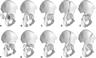 Classifications in Brief: Letournel Classification for Acetabular ...