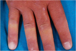 Cutaneous Manifestations of Scleroderma and Scleroderma-Like Disorders ...
