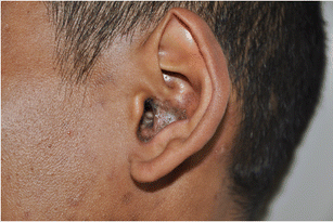 The Cutaneous Spectrum of Lupus Erythematosus | SpringerLink