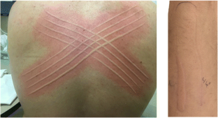 Urticaria and Angioedema: an Update on Classification and Pathogenesis ...