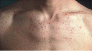 Skin Manifestations of Rheumatoid Arthritis, Juvenile Idiopathic ...