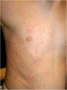 Skin Manifestations of Rheumatoid Arthritis, Juvenile Idiopathic ...