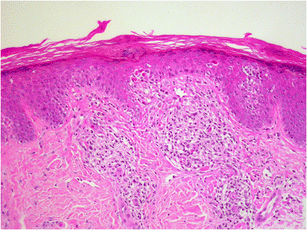 Cutaneous Manifestations of Dermatomyositis: a Comprehensive Review ...