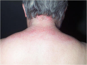 Cutaneous Manifestations of Dermatomyositis: a Comprehensive Review ...