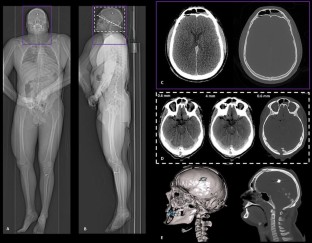 Imaging in forensic radiology: an illustrated guide for postmortem ...