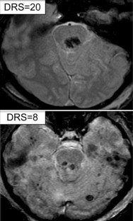 Revisiting Grade 3 Diffuse Axonal Injury: Not All Brainstem Microbleeds ...