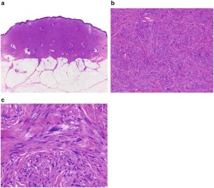 Primary leiomyosarcoma of the skin: a comprehensive review on diagnosis ...
