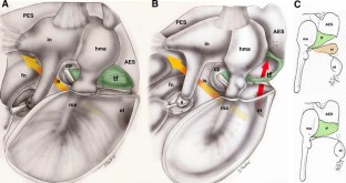 Endoscopic Anatomy of the Middle Ear | SpringerLink