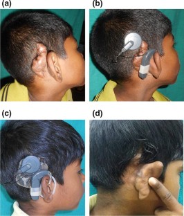 Ideal Flap Cover for the Salvage of Exposed/Infected Cochlear Implants ...