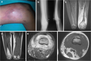 Bone and Joint Infections in Children: Acute Hematogenous Osteomyelitis ...