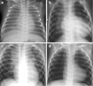 Clinical Approach to a Neonate with Cyanosis | SpringerLink