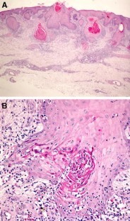 Bazex Syndrome (Acrokeratosis Paraneoplastica) Diagnosed in a Patient ...