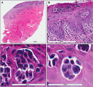 Large Cell Transformation of Oral Mycosis Fungoides | SpringerLink