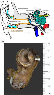 Squamous Cell Carcinoma of the External Auditory Canal and Temporal ...