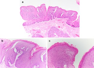 HPV-Related Papillary Lesions of the Oral Mucosa: A Review | SpringerLink