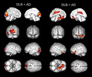 Cingulate island sign on FDG-PET is associated with medial temporal ...