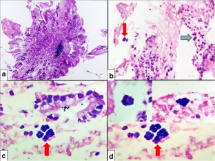 Sarcina ventriculi : Pathogenic or Benign Commensal? A Clinician Should ...