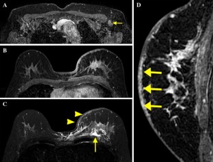 MRI findings of inflammatory breast cancer, locally advanced breast ...