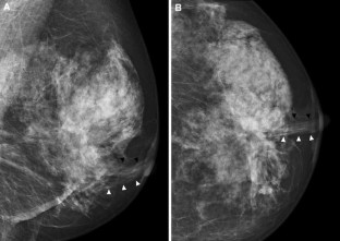 What we should know in mammography after reduction mammoplasty and ...