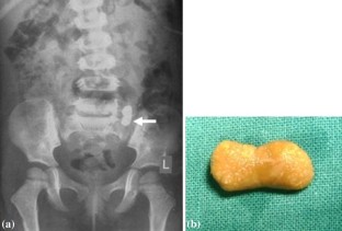 Cystine Urolithiasis in Early Childhood | SpringerLink
