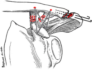 Modified Phemister procedure for the surgical treatment of Rockwood ...