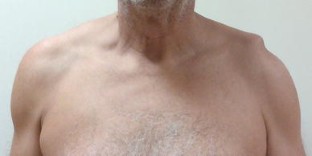 Modified Phemister procedure for the surgical treatment of Rockwood ...