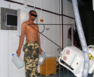 Modified Phemister procedure for the surgical treatment of Rockwood ...