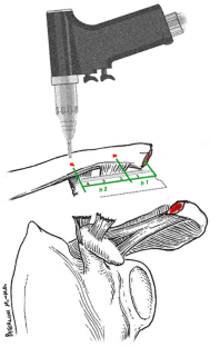 Modified Phemister procedure for the surgical treatment of Rockwood ...