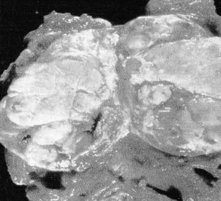 Pleomorphic spindle cell sarcoma (PSCS) formerly known as malignant ...