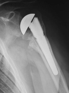 A preformed antibiotic-loaded spacer for treatment for septic arthritis ...