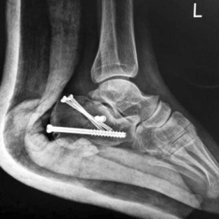 Percutaneous reduction and screw fixation for all types of intra ...