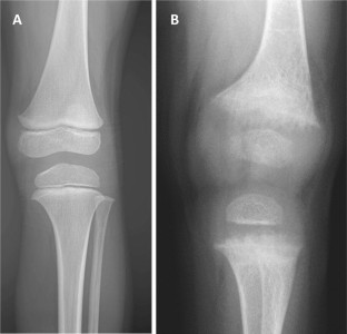 Usefulness of X-rays in the Differential Diagnosis of Hypophosphataemic ...